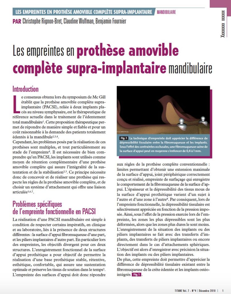 Prothèse amovible complète supra implantaire mandibulaire